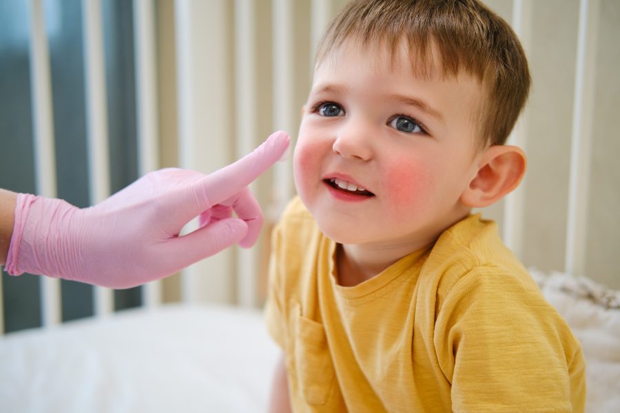 Αναφυλαξία στα παιδιά - Mothersblog.gr
